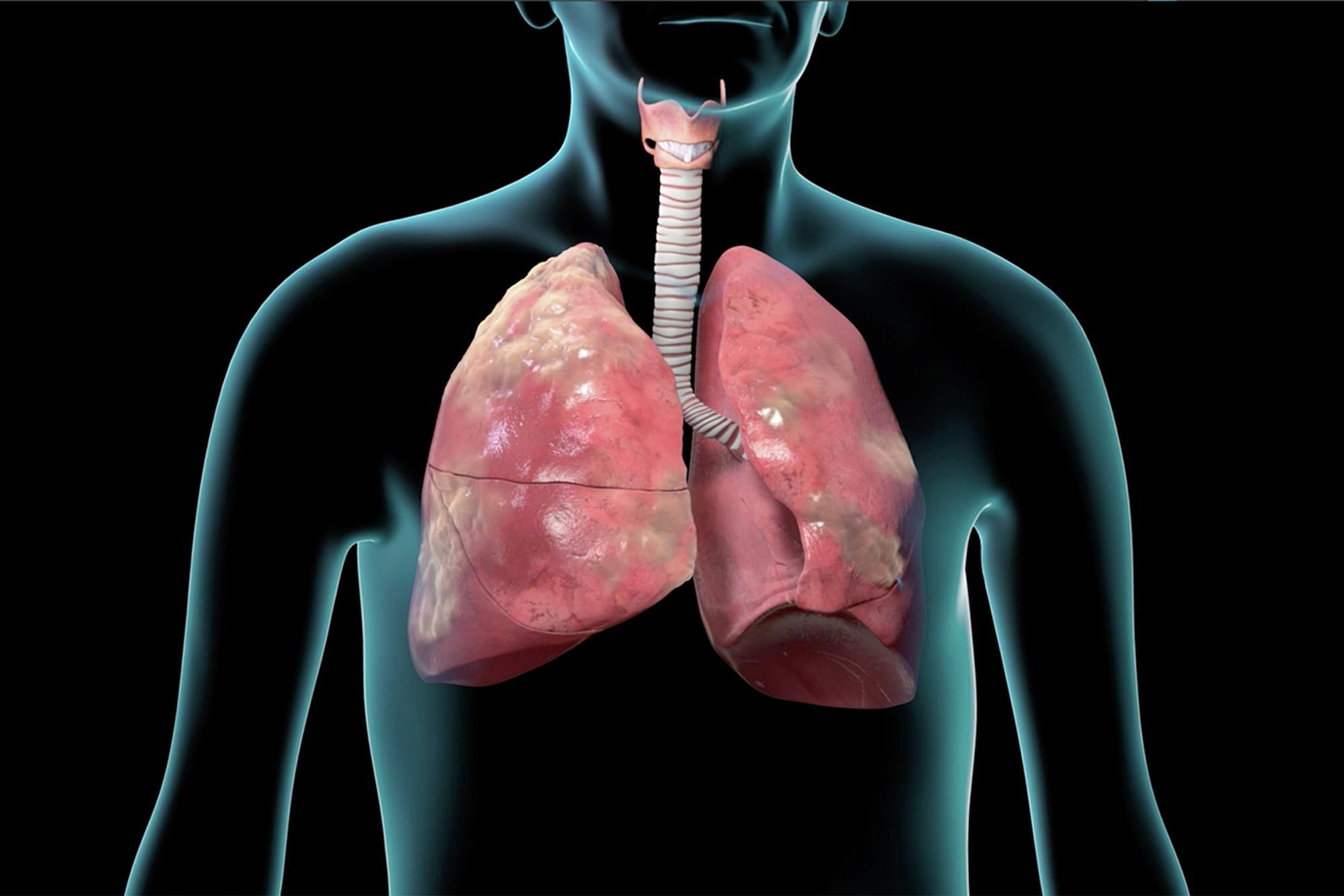 COPD is Diagnosed and Treated by Top Rated Doctors at Mercy in Baltimore