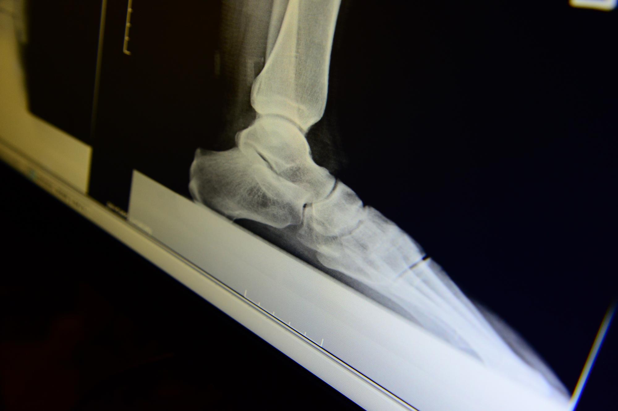 Osteochondral Defect (OCD) Ankle/Talus - Osteochondritis Dissecans ...