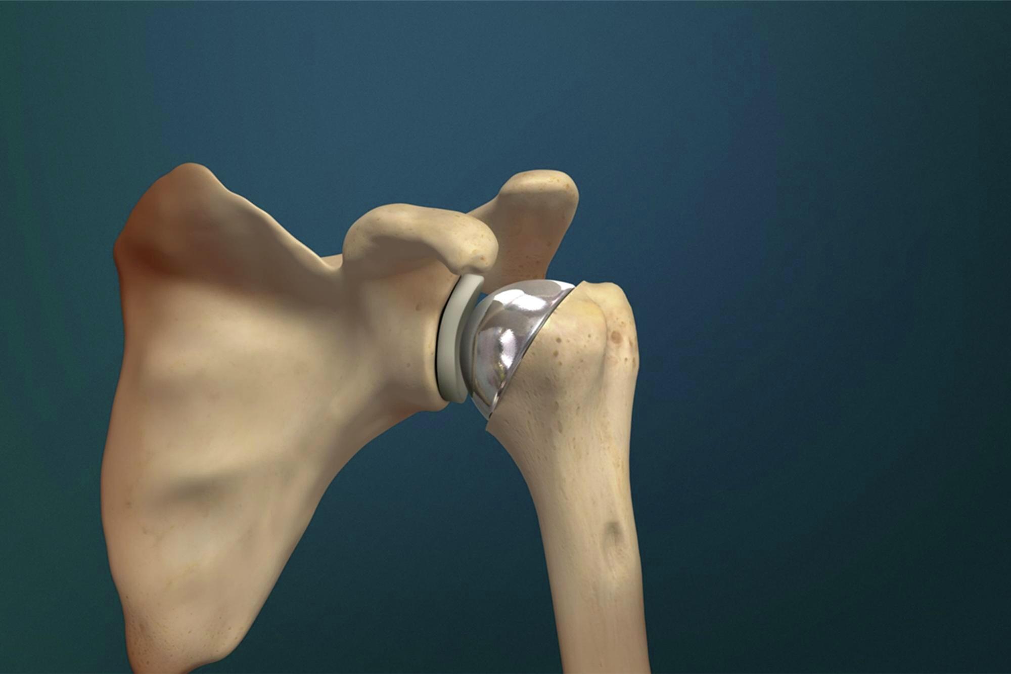 Total Shoulder Replacement Performed in Baltimore - Mercy Medical Center