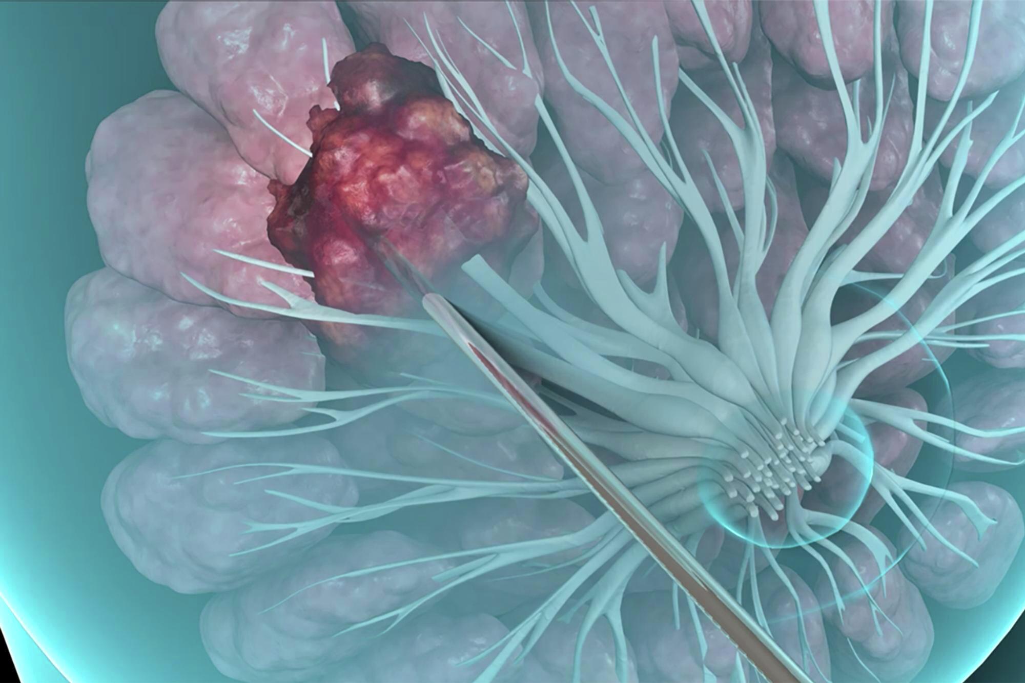 Minimally Invasive Biopsies Of The Breast Mercy Baltimore