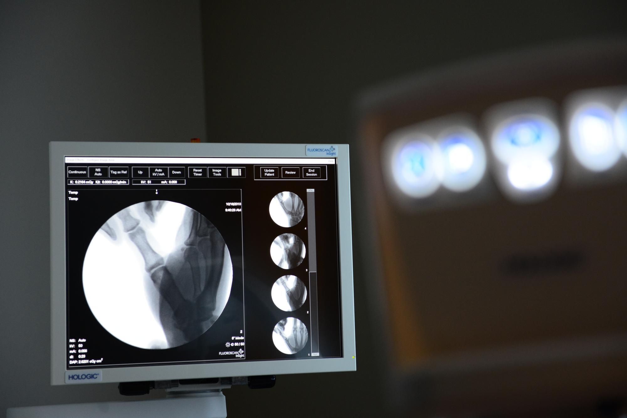 Open Reduction Internal Fixation Offered in Baltimore - Mercy