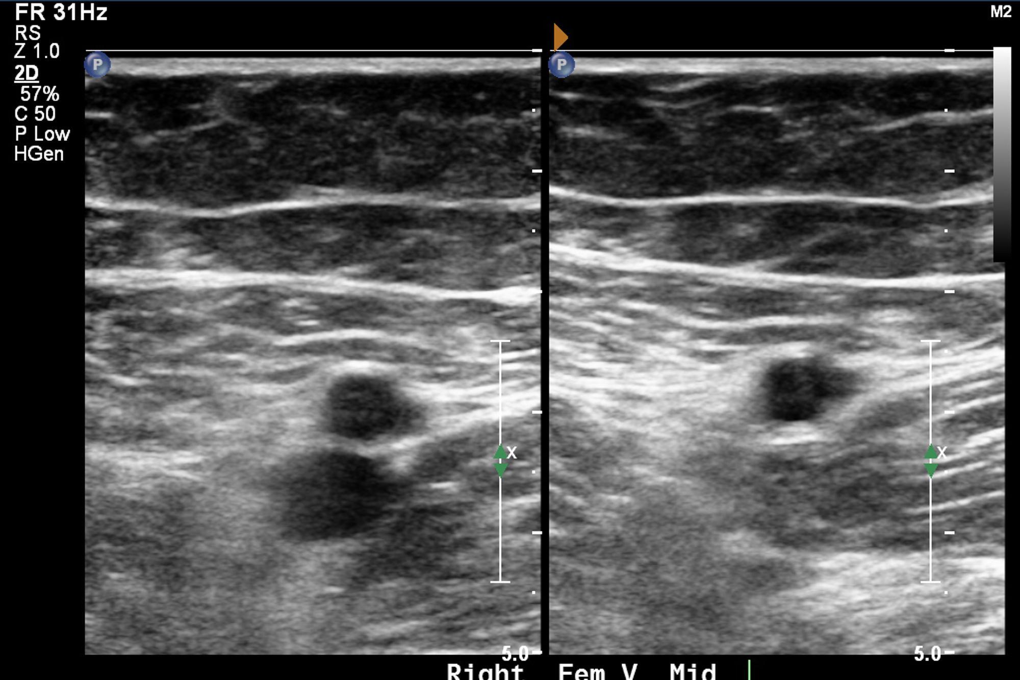 Venous Duplex Ultrasound Offered in Baltimore - Mercy