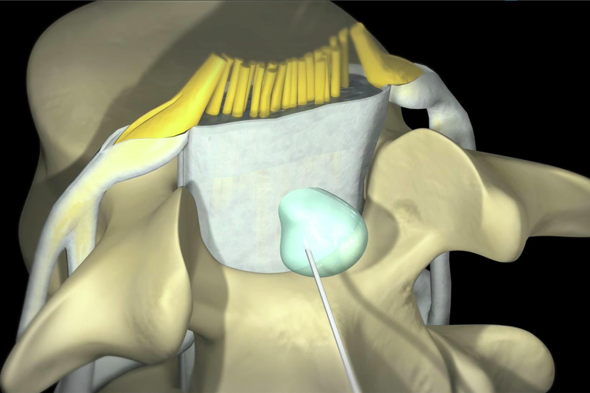 Epidural Injections Offered by Pain Medicine Specialists - Baltimore, MD